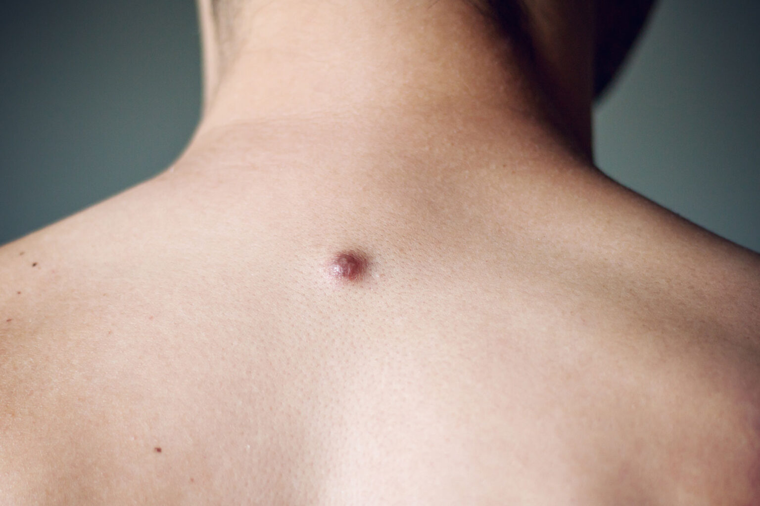 Skin and Soft Tissue Lesions - Middle Georgia Surgery Institute